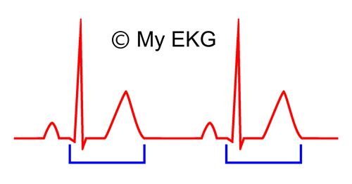 QT Interval