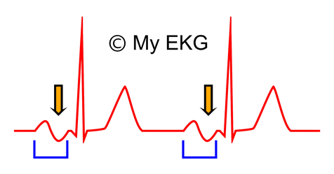 Bayés Syndrome and Interatrial Blocks