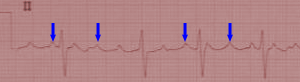 Atrial Flutter, Electrocardiogram Characteristics